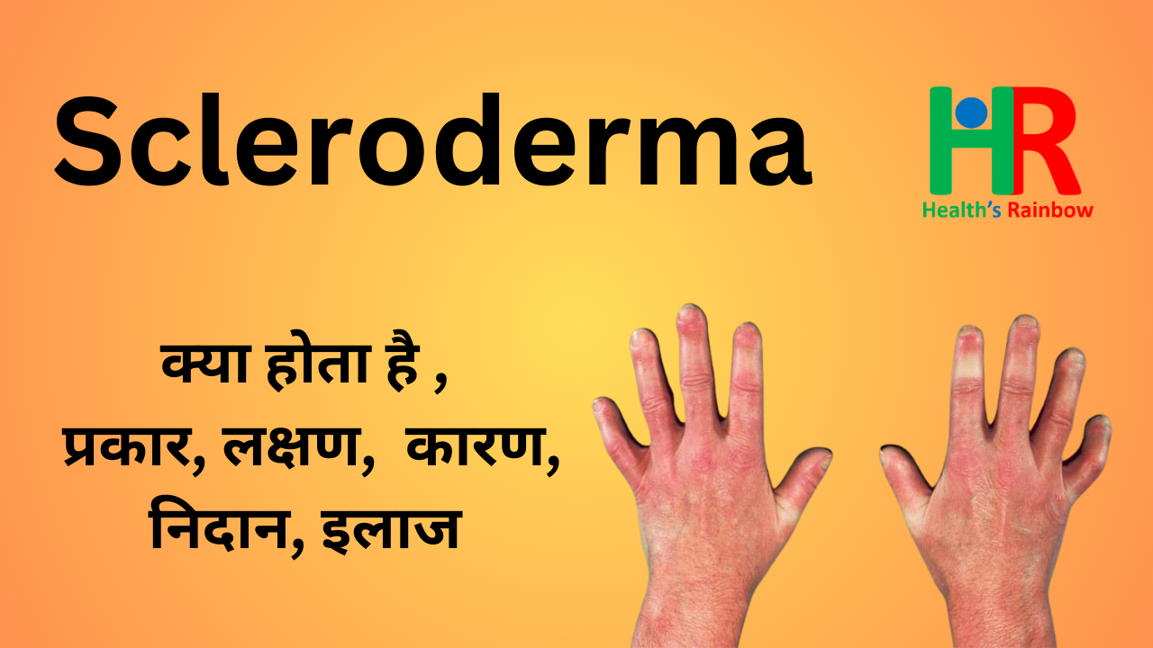 Scleroderma: A Comprehensive Guide